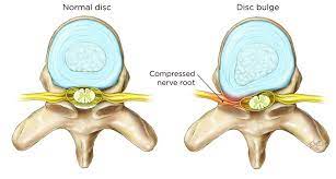 Disc Bulge and Herniation: Cervical Spine - Themovementmill